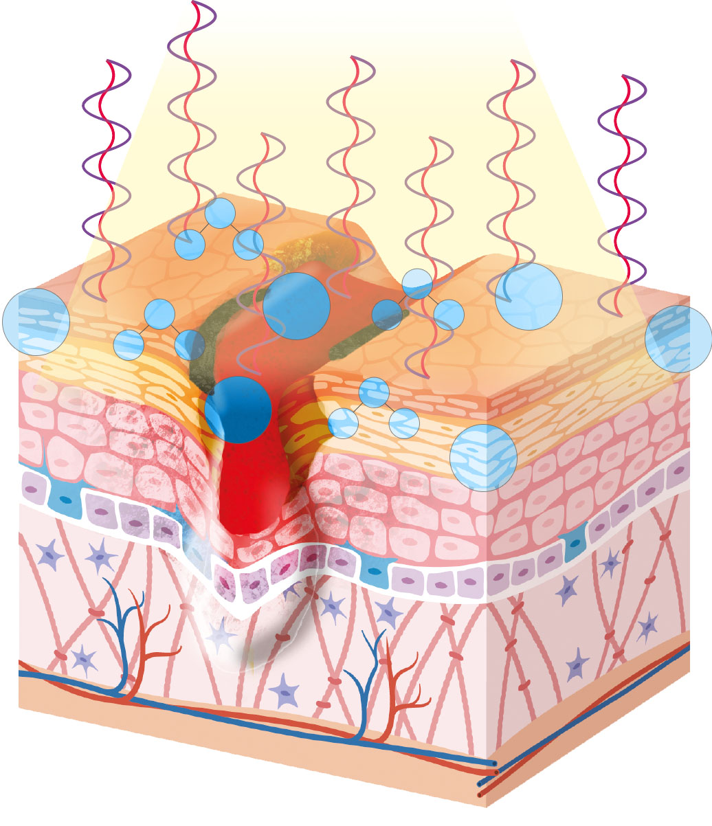 Wound treatment method - LASEROBARIA method of wound treatment